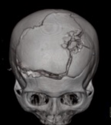 Bullet, Nail & Bolt: Penetrating Brain Injuries in Austria - PharmiWeb.com
