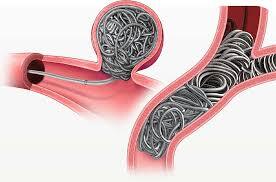 Embolization Coils Market: A Key Player in Modern Vascular Treatments ...