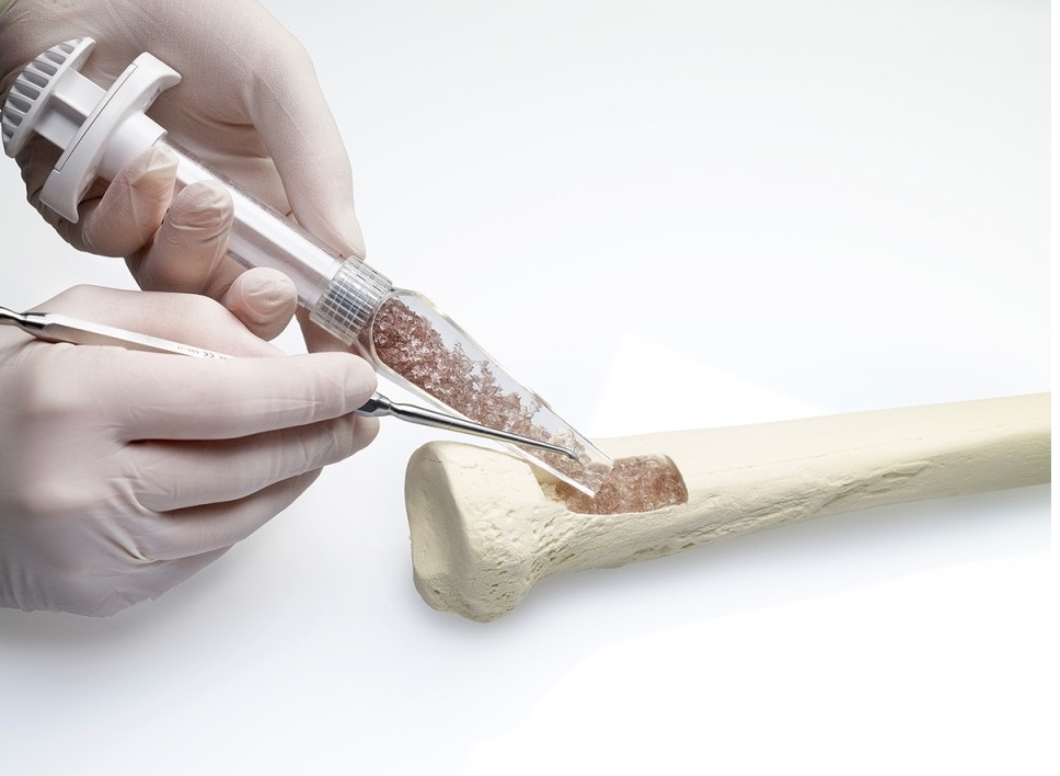 Bone Graft Substitutes Market (2024-2035) – Trends, Growth Drivers, and ...
