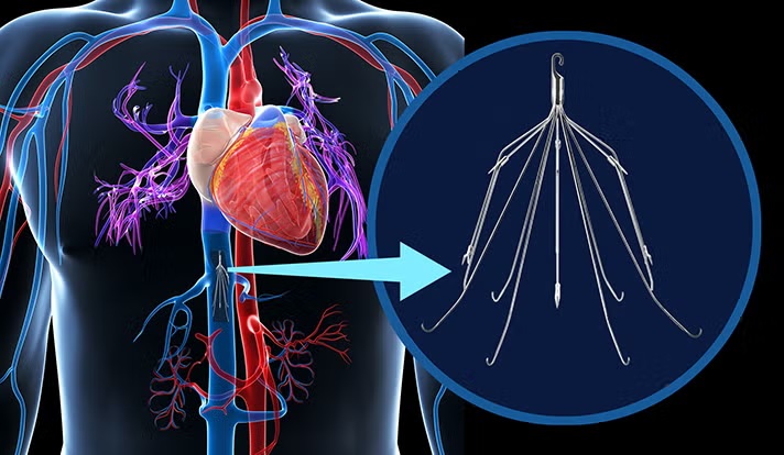 Understanding The Growth Of The Inferior Vena Cava (IVC) Filter Market ...