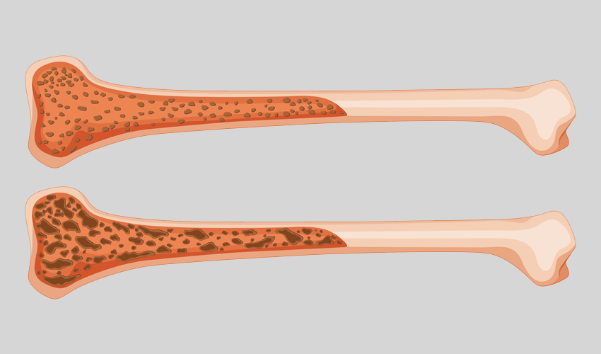 Life After Leukemia: How the Global Bone Marrow Transplantation Market ...