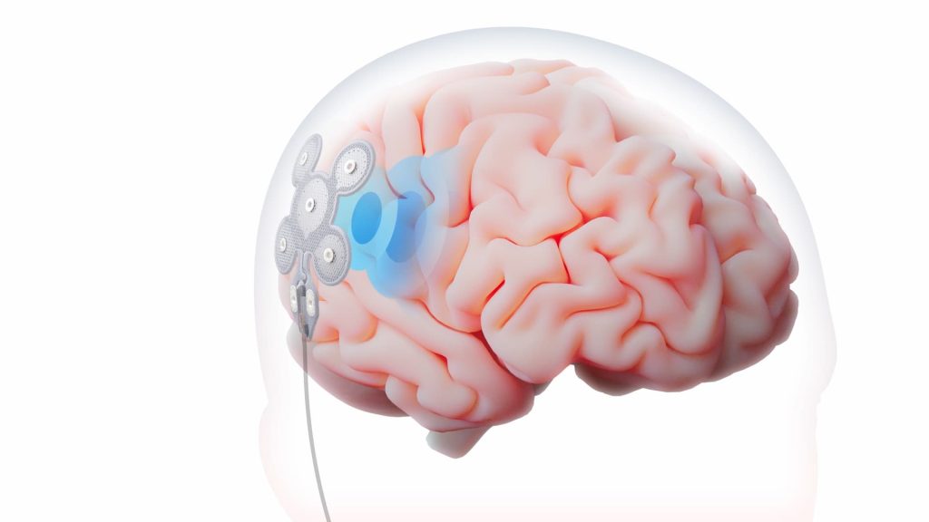 Brain Pacemaker Market: Revolutionizing Neurological Treatment Through ...